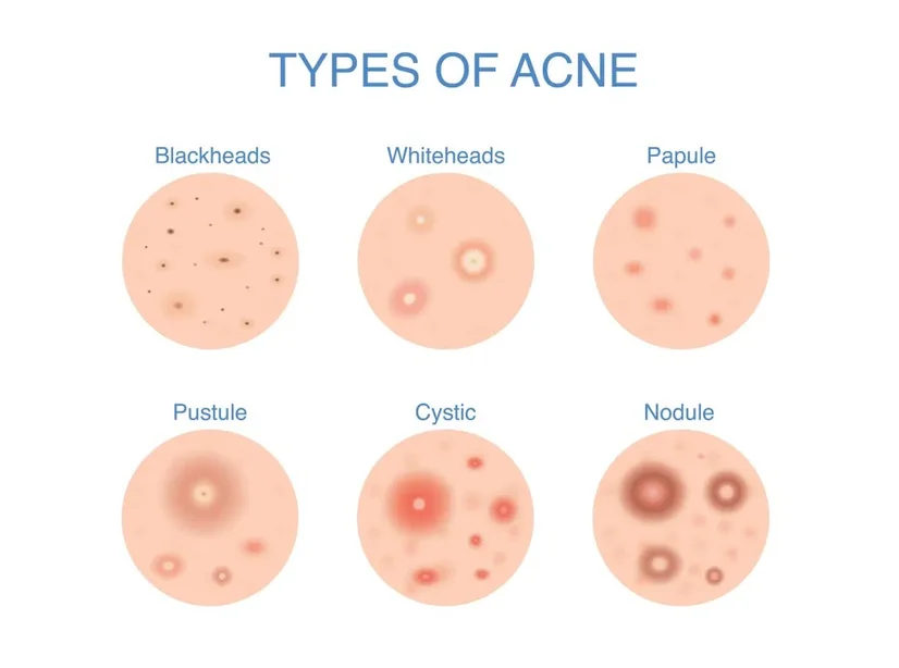 Best Acne Treatments in 2025 as reviewed by Australian consumers | ProductReview.com.au