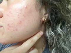 Best Acne Treatments in 2025 as reviewed by Australian consumers ...